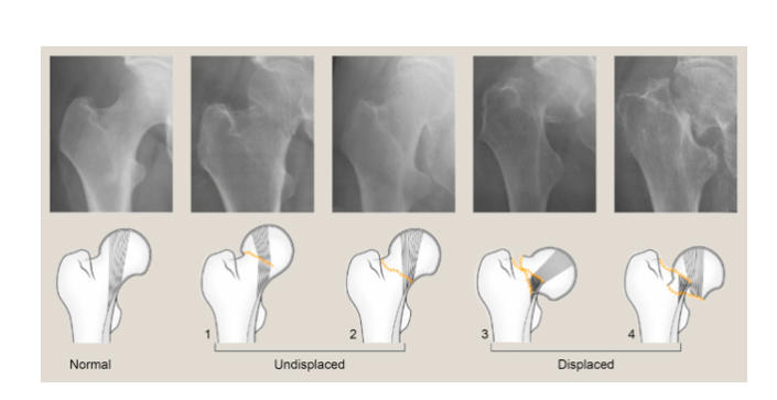 Collum femoris fraktur – NOMS