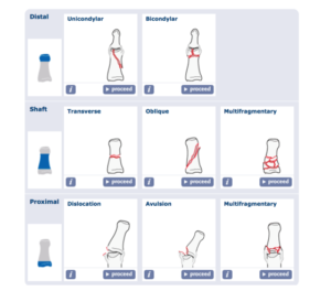 1.-5. Finger fraktur – NOMS