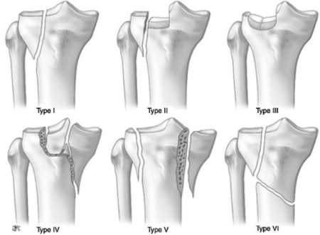 Proximal Tibia Frakturer – NOMS