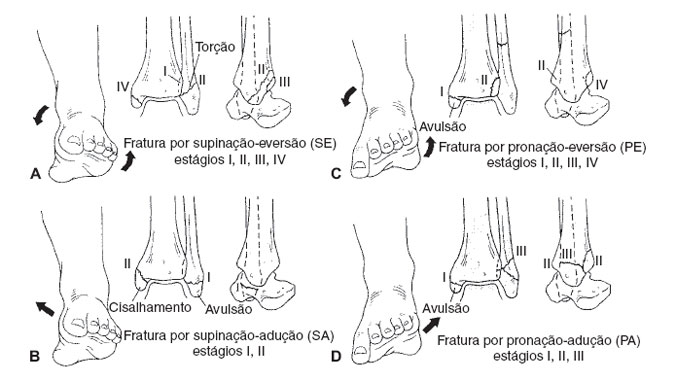 Ankel Fraktur – NOMS