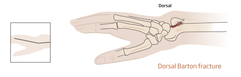 Distal radius fraktur – NOMS
