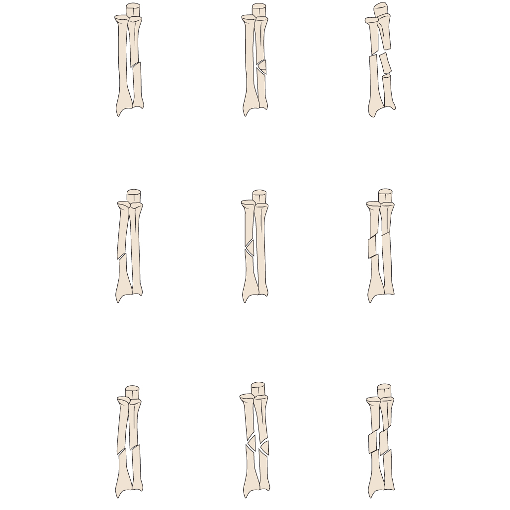 Antebrachium fraktur – NOMS