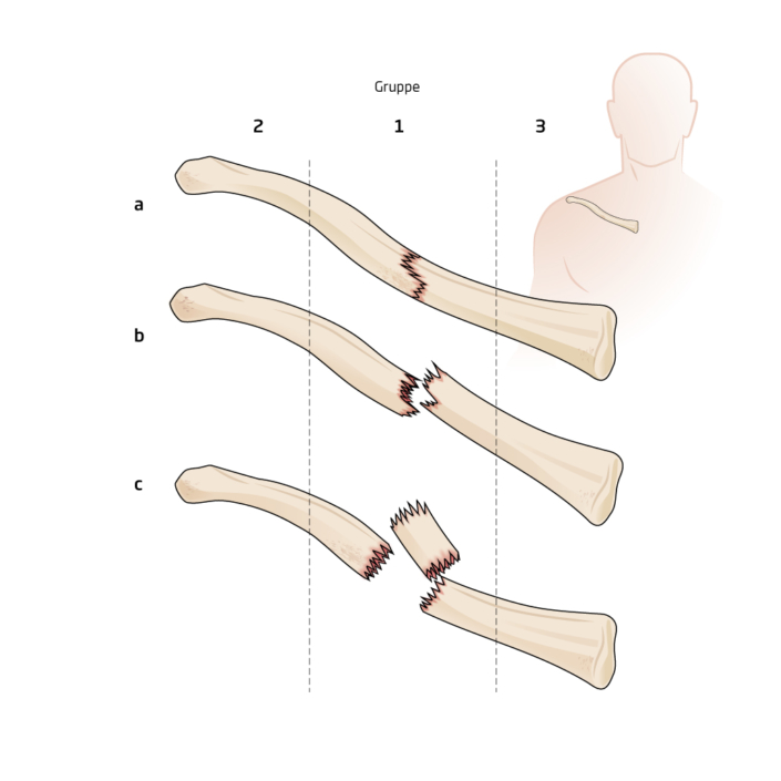 Klavikel fraktur – NOMS