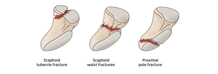 Scaphoideum fraktur – NOMS