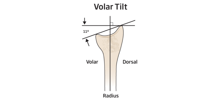 Distal radius fraktur – NOMS