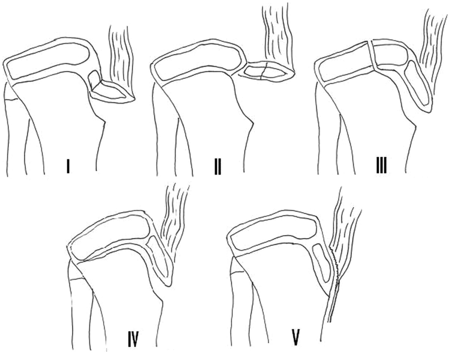 Børnefraktur af tuberositas tibia – NOMS