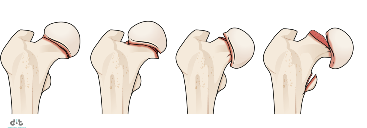 Collum femoris fraktur – NOMS